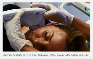 Ask Cheryl | What is Skin Tightening with RF? | SkinHealth Centers